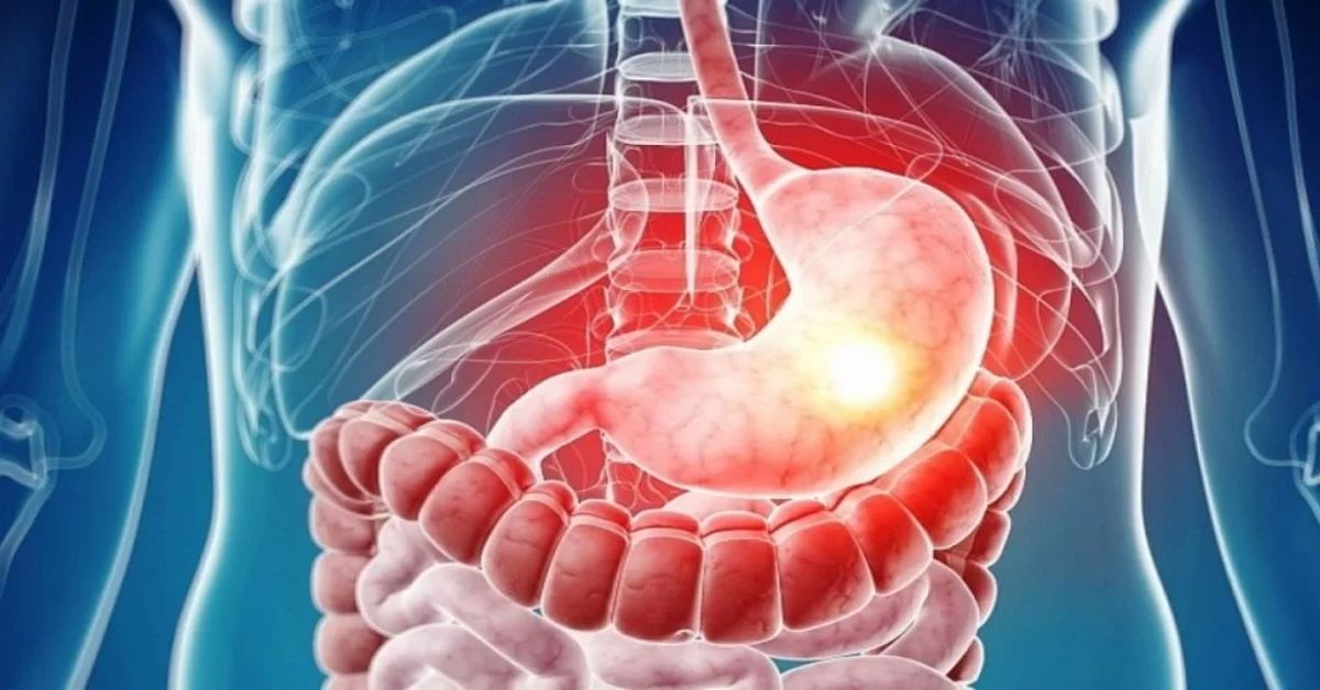 Gastrit Hastalığı Tedavisi - Prof. Dr. Cengiz Pata